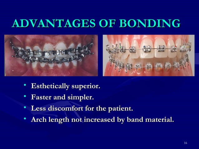 Bonding in orthodontics | PPT