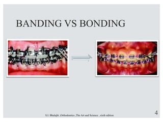 bonding inorthodontics (2).pptx