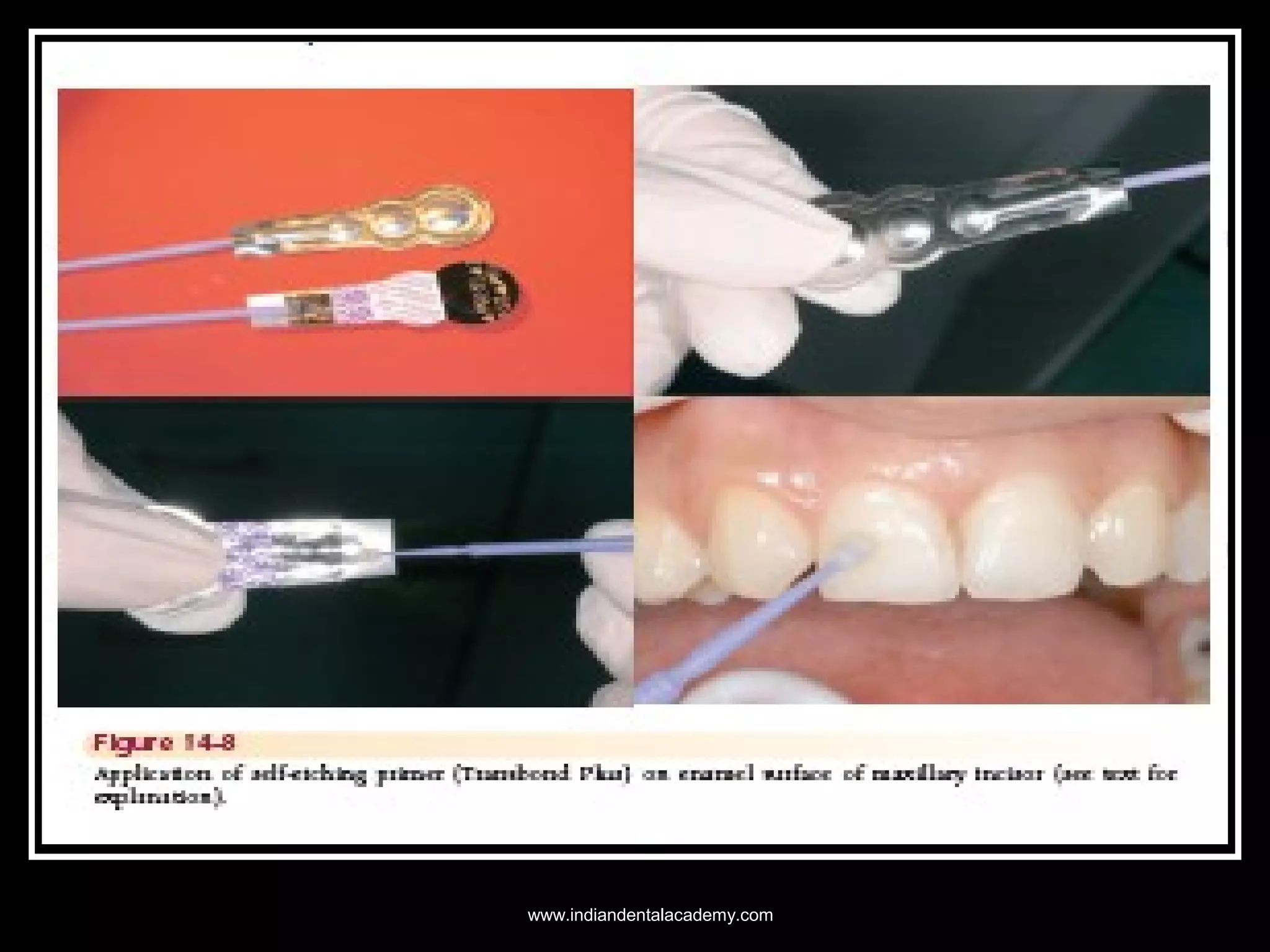 Bonding in orthodontics | PPT | Dental Health | Diseases and Conditions