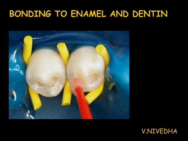 Bonding to enamel and dentin | PPTX | Dental Health | Diseases and ...