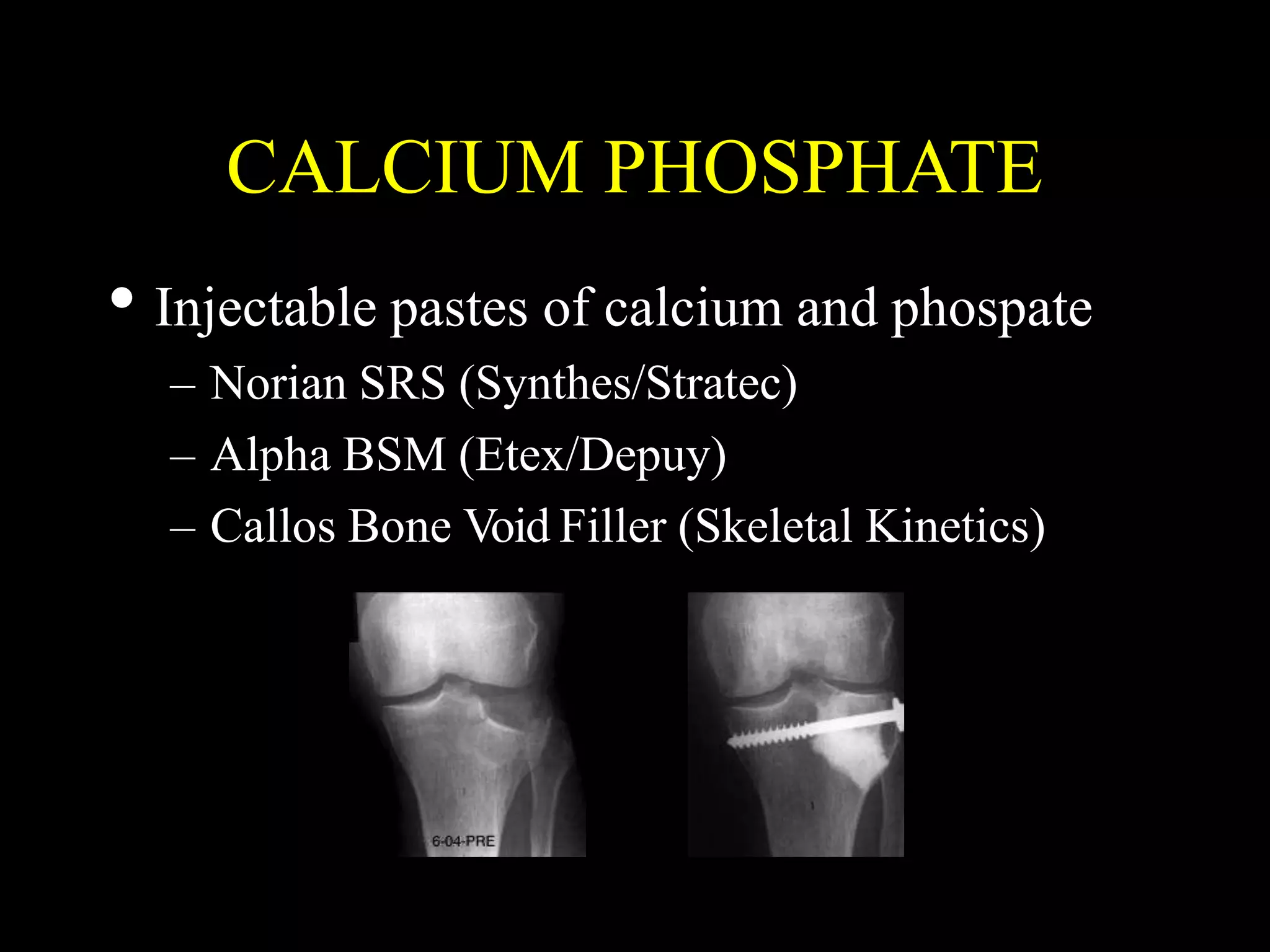 Bone substitutes | PPTX