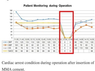 Bone-Cement-Implantation-Syndrome-BCIS.pptx