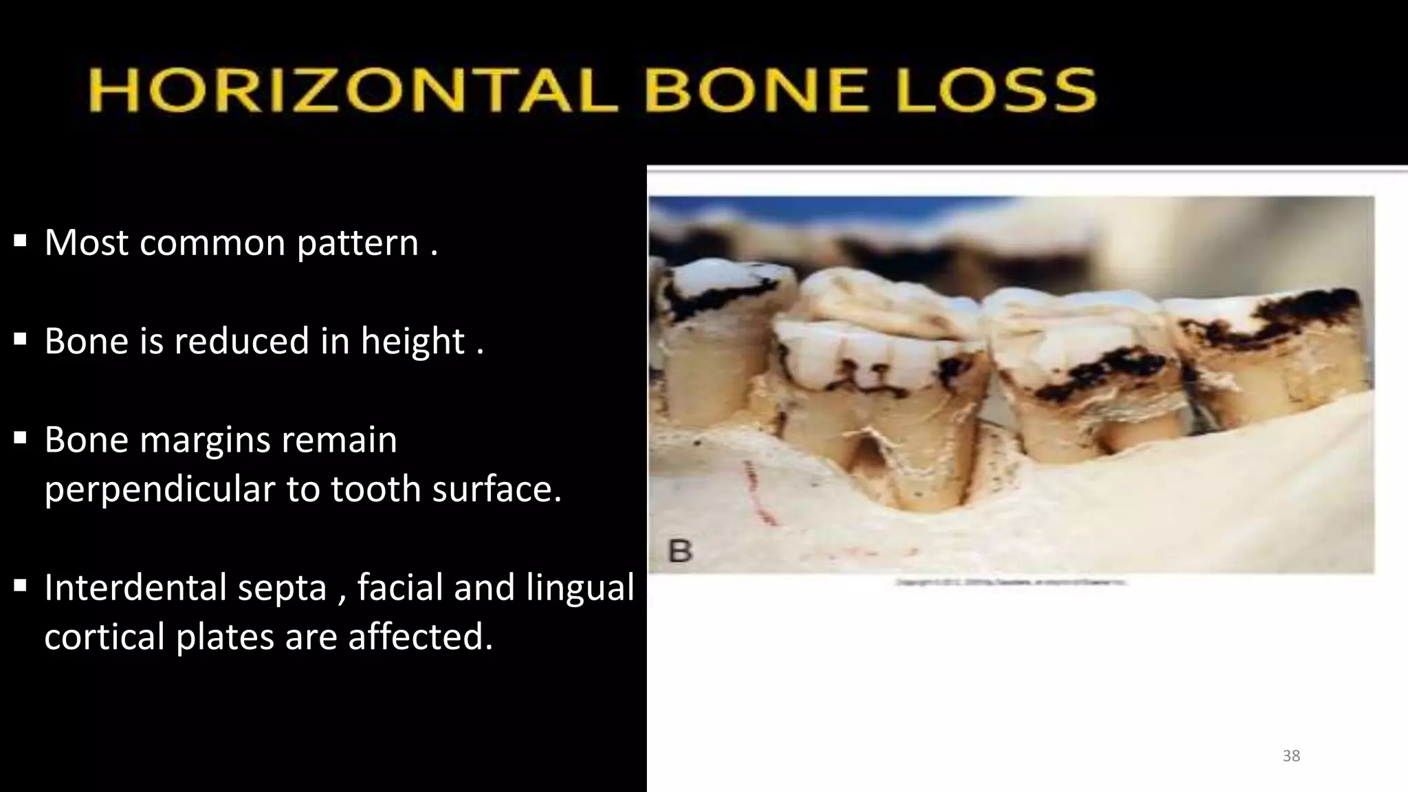 BONE-DESTRUCTION-PATTERNS-20208171318390.pptx