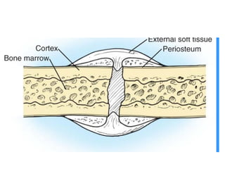 Bone grafts and bone grafts substitutes | PPT