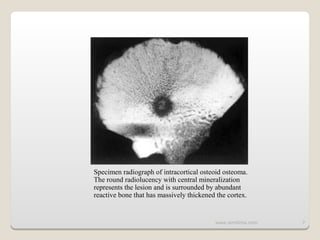 bone-tumors cartilaginous and bone cells.pdf