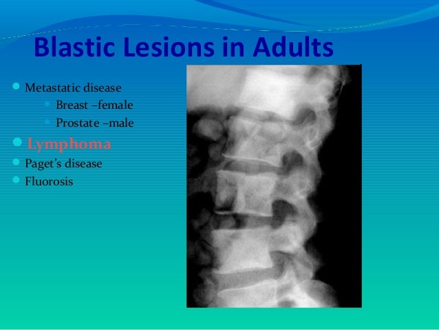 Bone tumors muhammad 1