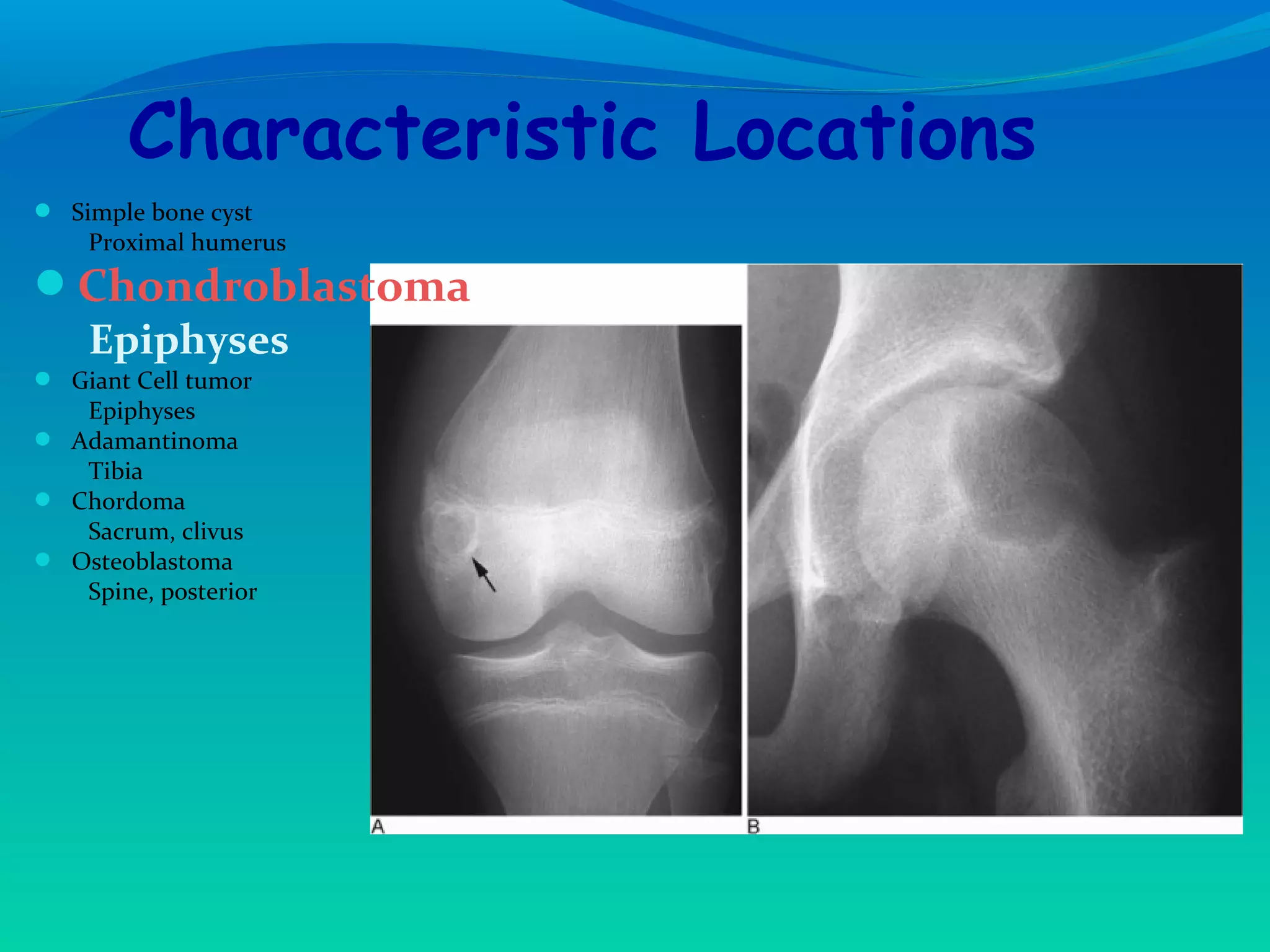 Bone tumors muhammad 1 | PPT