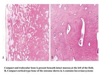 bone tumor | PPTX