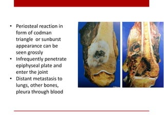 bone tumor | PPTX