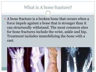 Bone Fractures | PPTX