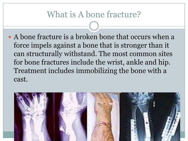 Bone Fractures | PPT