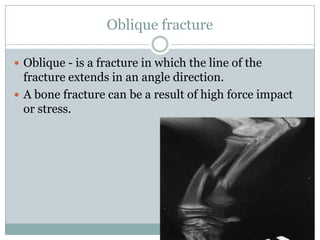 Bone Fractures | PPTX