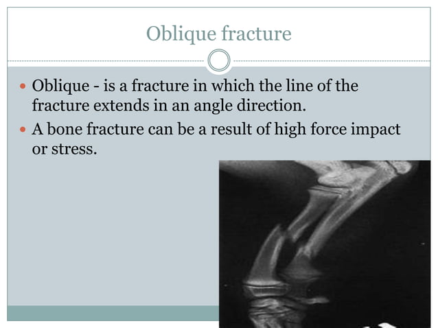 Bone Fractures | PPT