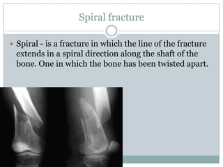 Bone Fractures | PPTX