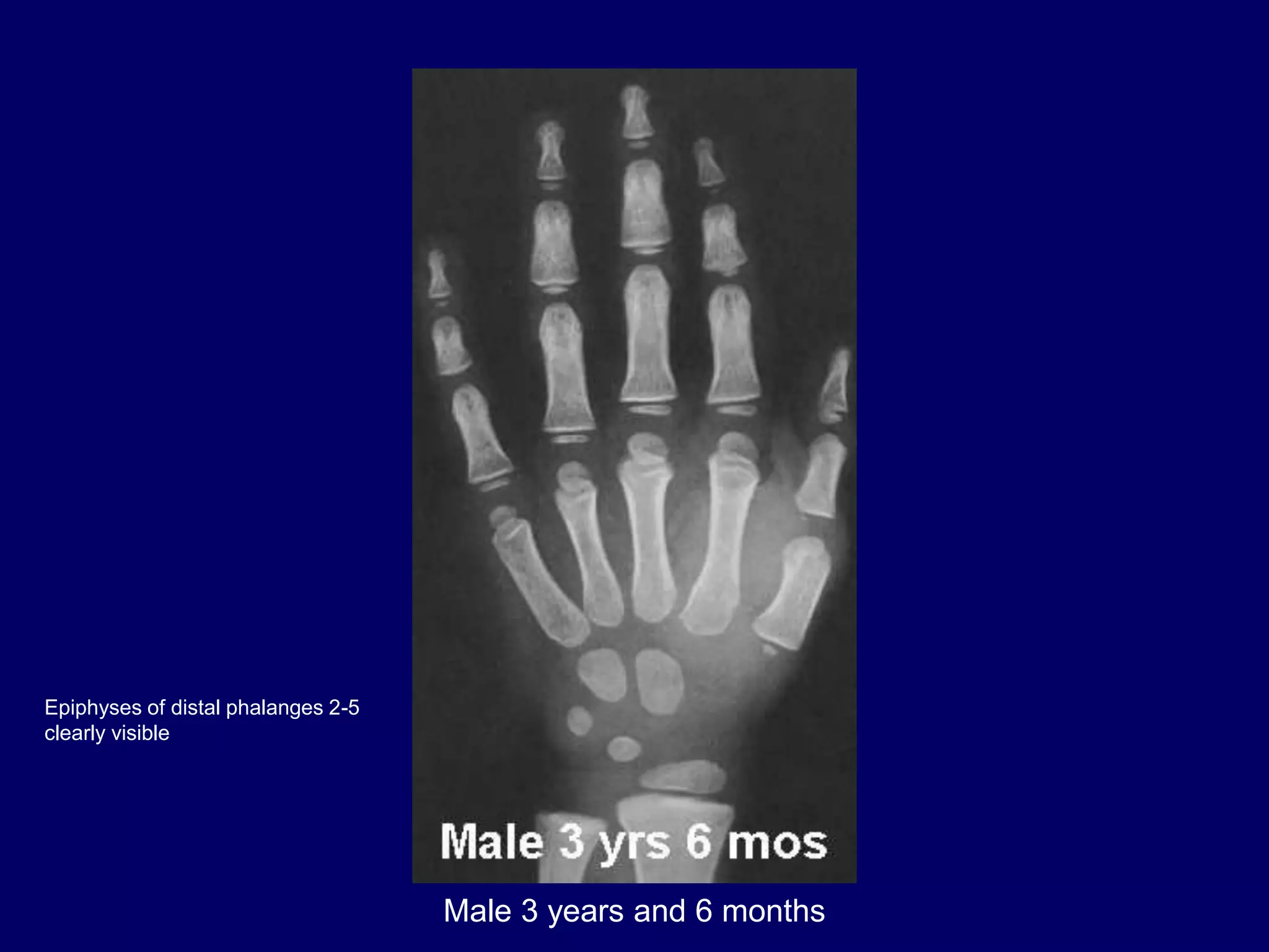 bone age .pptx