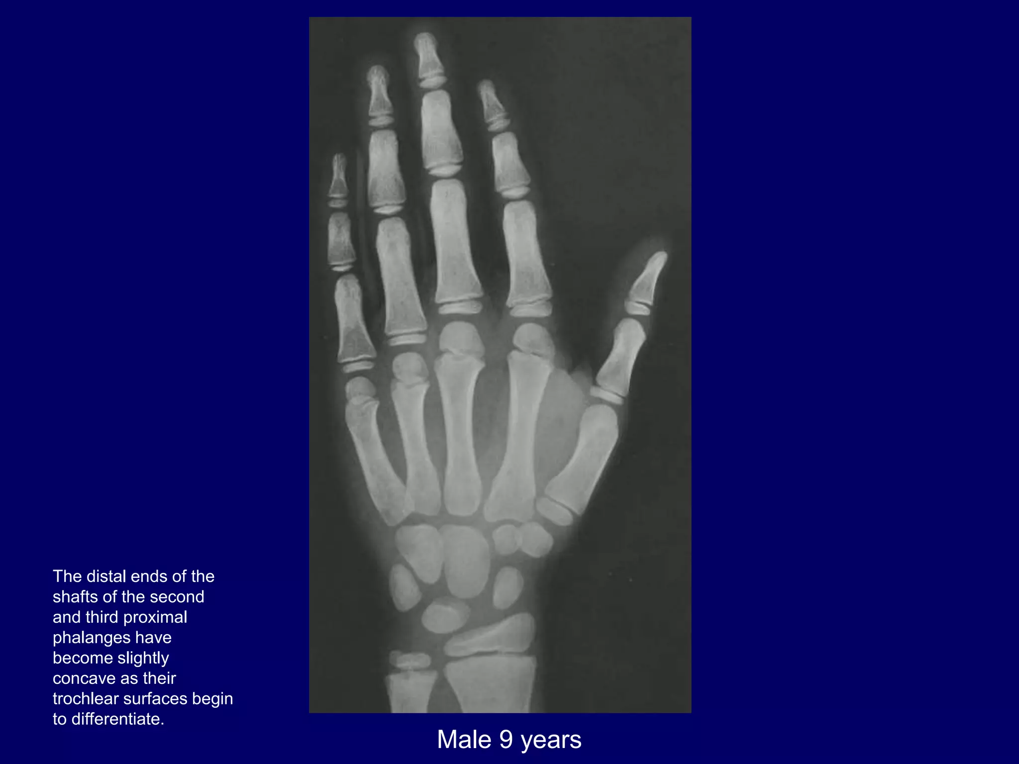 bone age .pptx