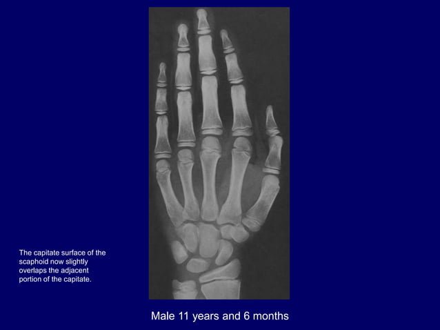 Bone Age Pptx