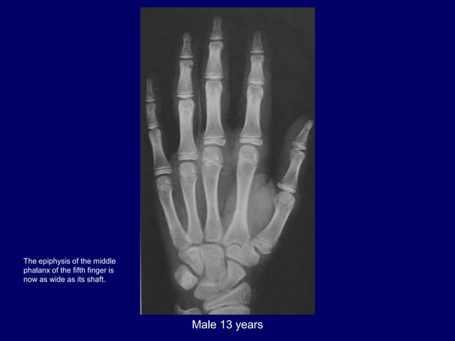 Bone Age Pptx