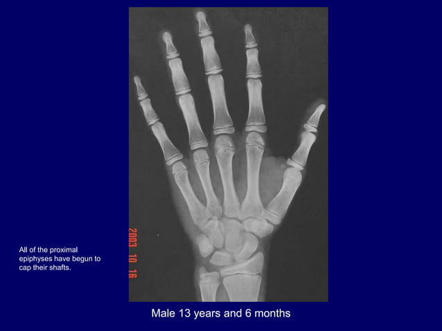 Bone Age Pptx