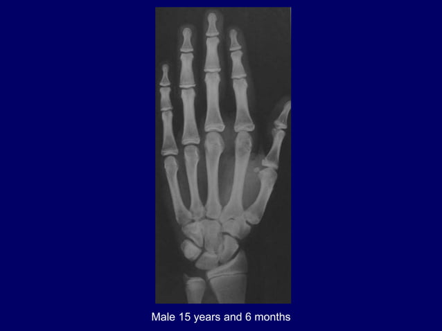 bone age .pptx