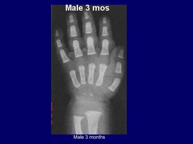 bone age .pptx