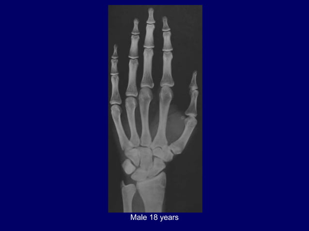 bone age .pptx