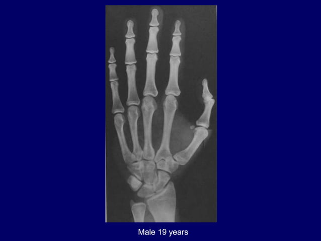 bone age .pptx