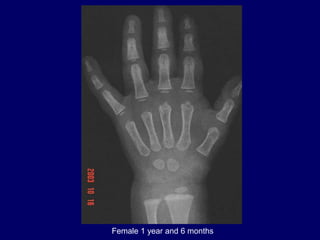 bone age .pptx