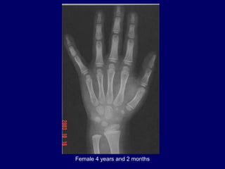 bone age .pptx