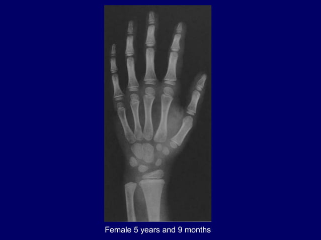 Bone Age Pptx