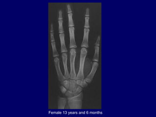 bone age .pptx