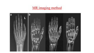 Bone age assessent | PPTX