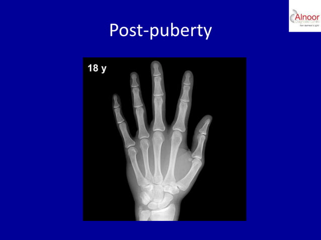 Bone age assessment | PPTX | Menopause | Endocrine and Metabolic Diseases