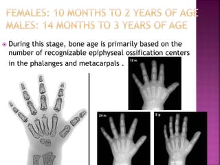Bone age assessment dr ankita | PPTX
