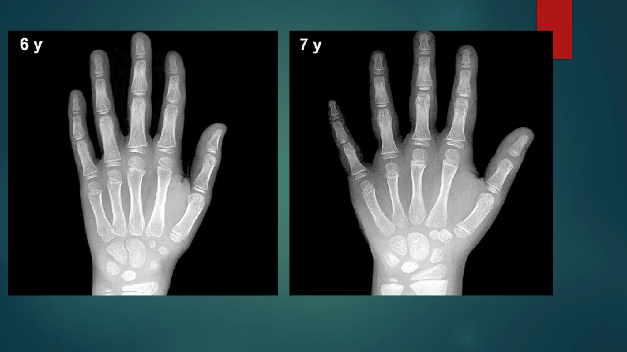 Bone age determination by assessment of skeletal maturity.pptx
