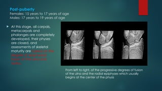 Bone age determination by assessment of skeletal maturity.pptx