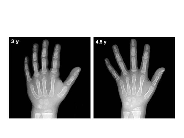 Bone age estimation | PPT