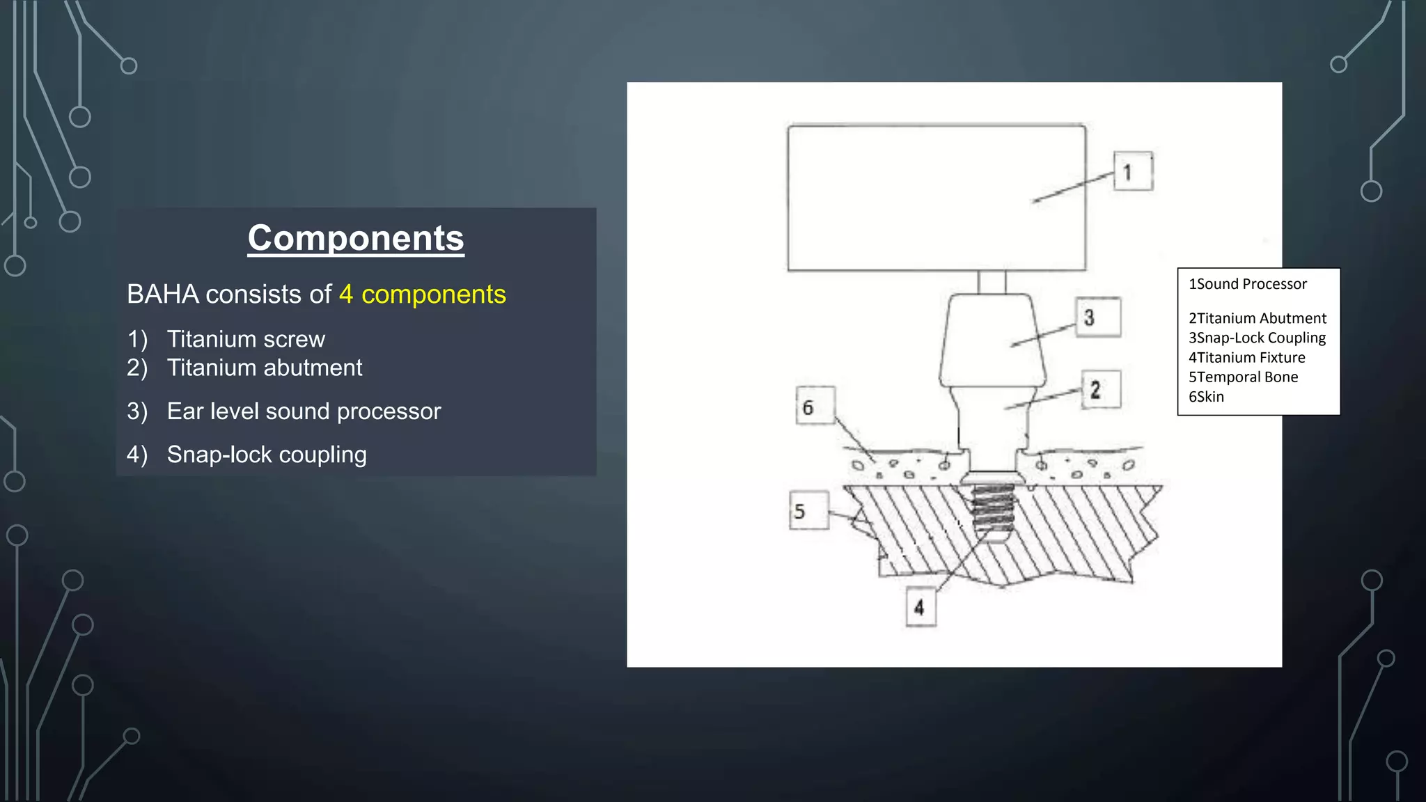 Bone Anchored Hearing Aids (BAHA).pptx
