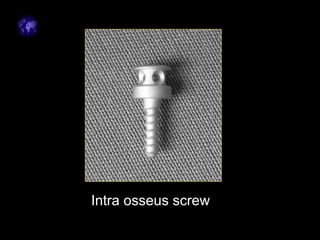 Bone anchored pendulum appliance. (2) | PPT