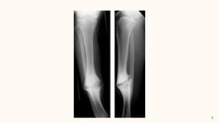 Bone and Fracture Healing powerpoint for resident | PPTX