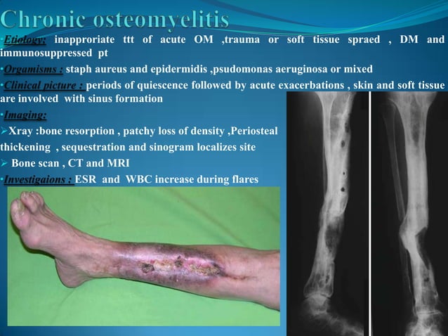 Bone and joint infection