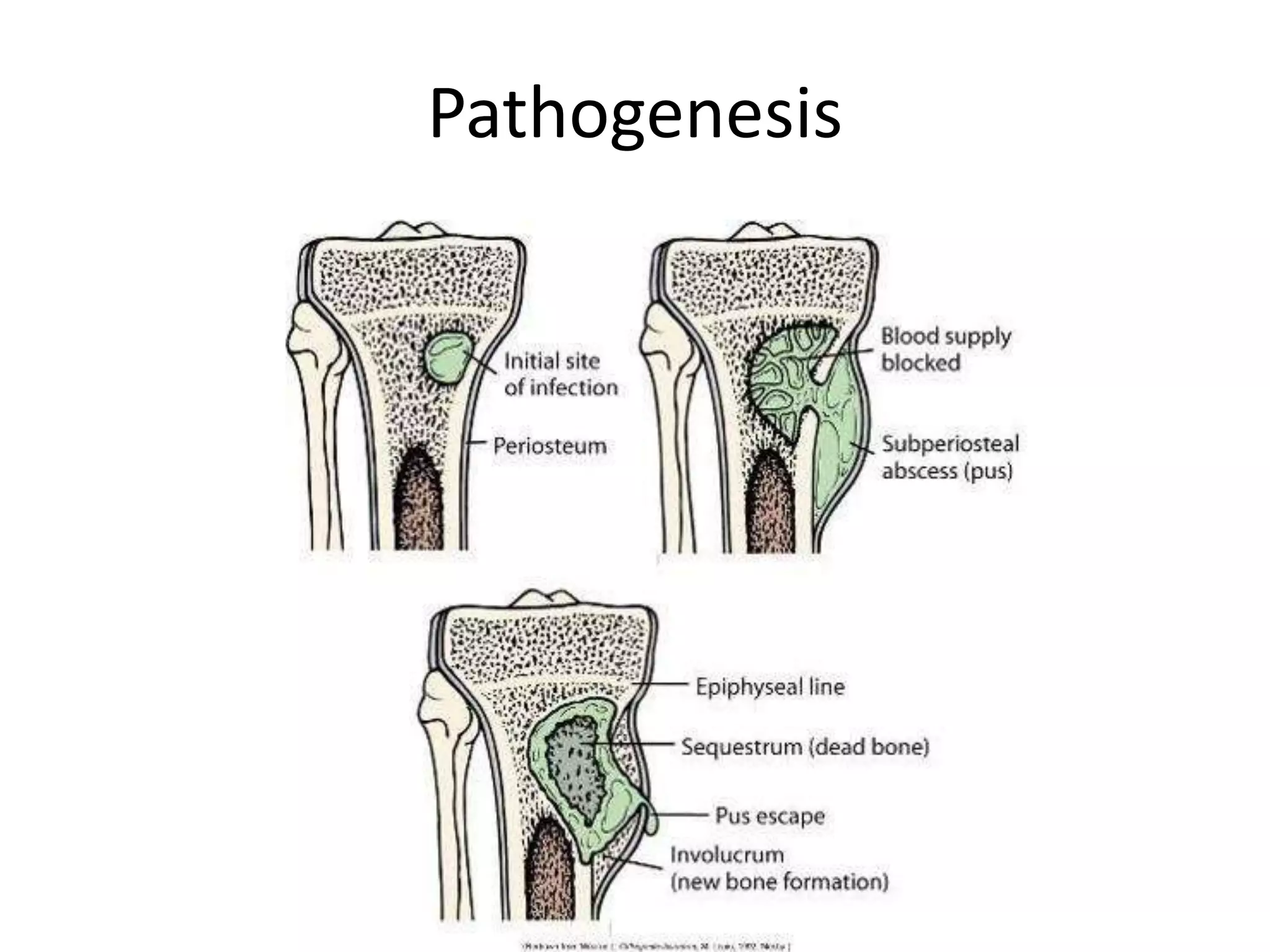 Bone and joint infection presentation | PPTX