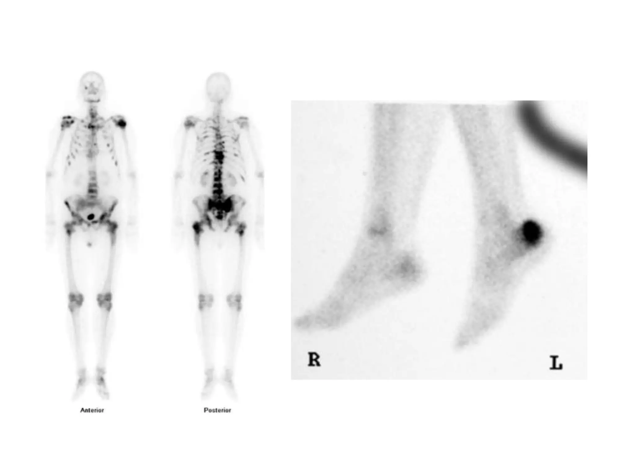 Bone and joint infection presentation | PPTX