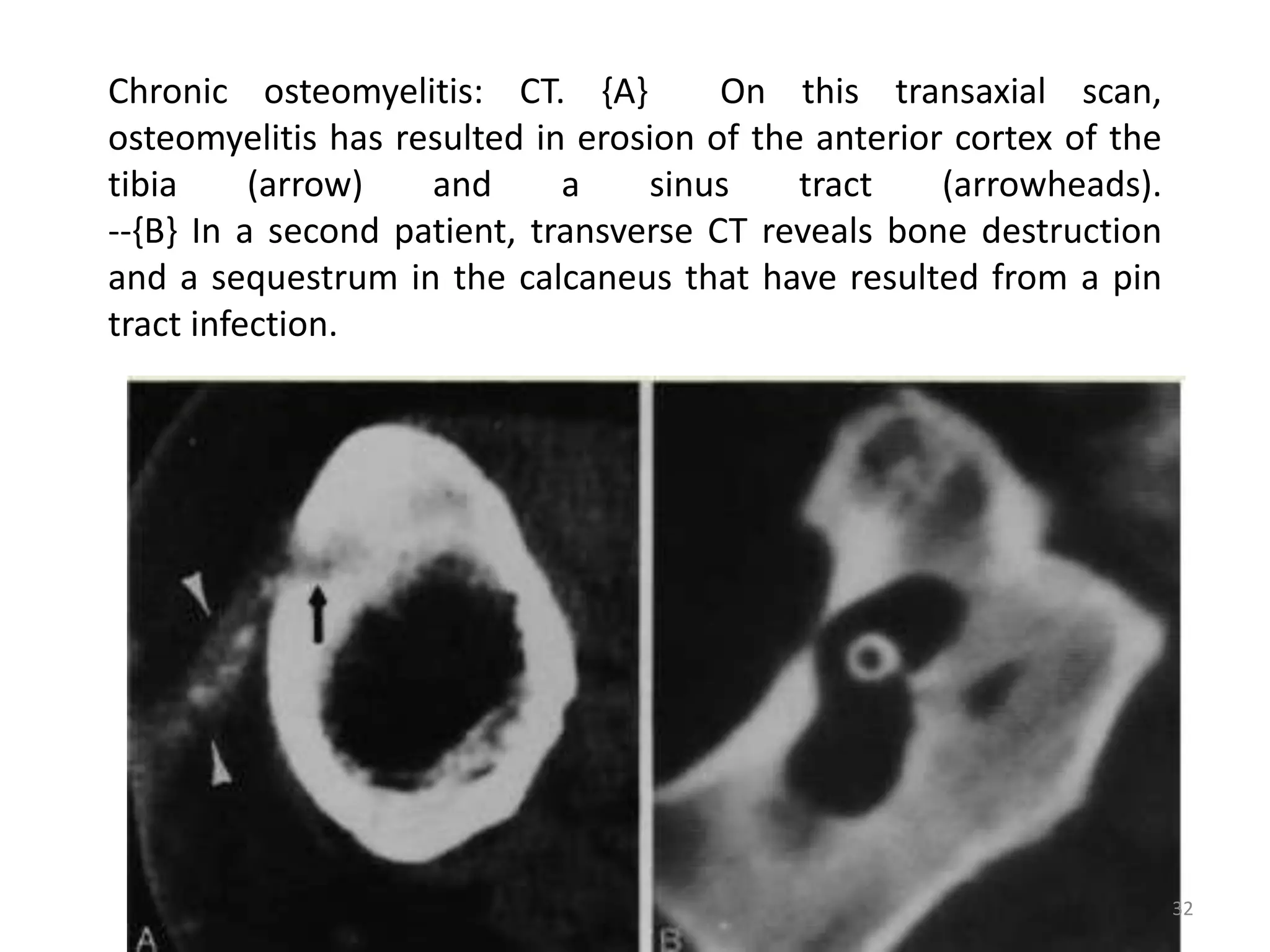 Bone and joint infection presentation | PPTX