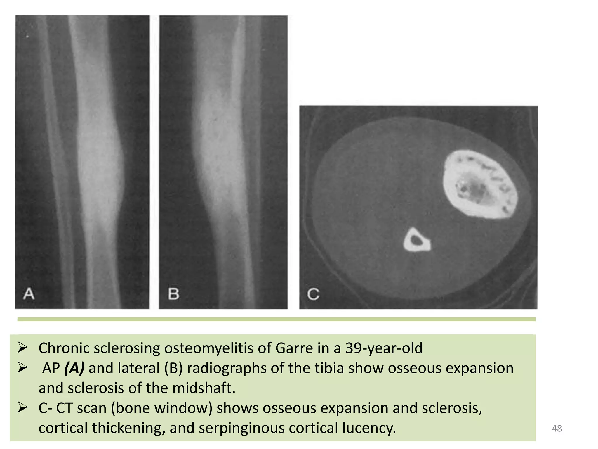 Bone and joint infection presentation | PPTX