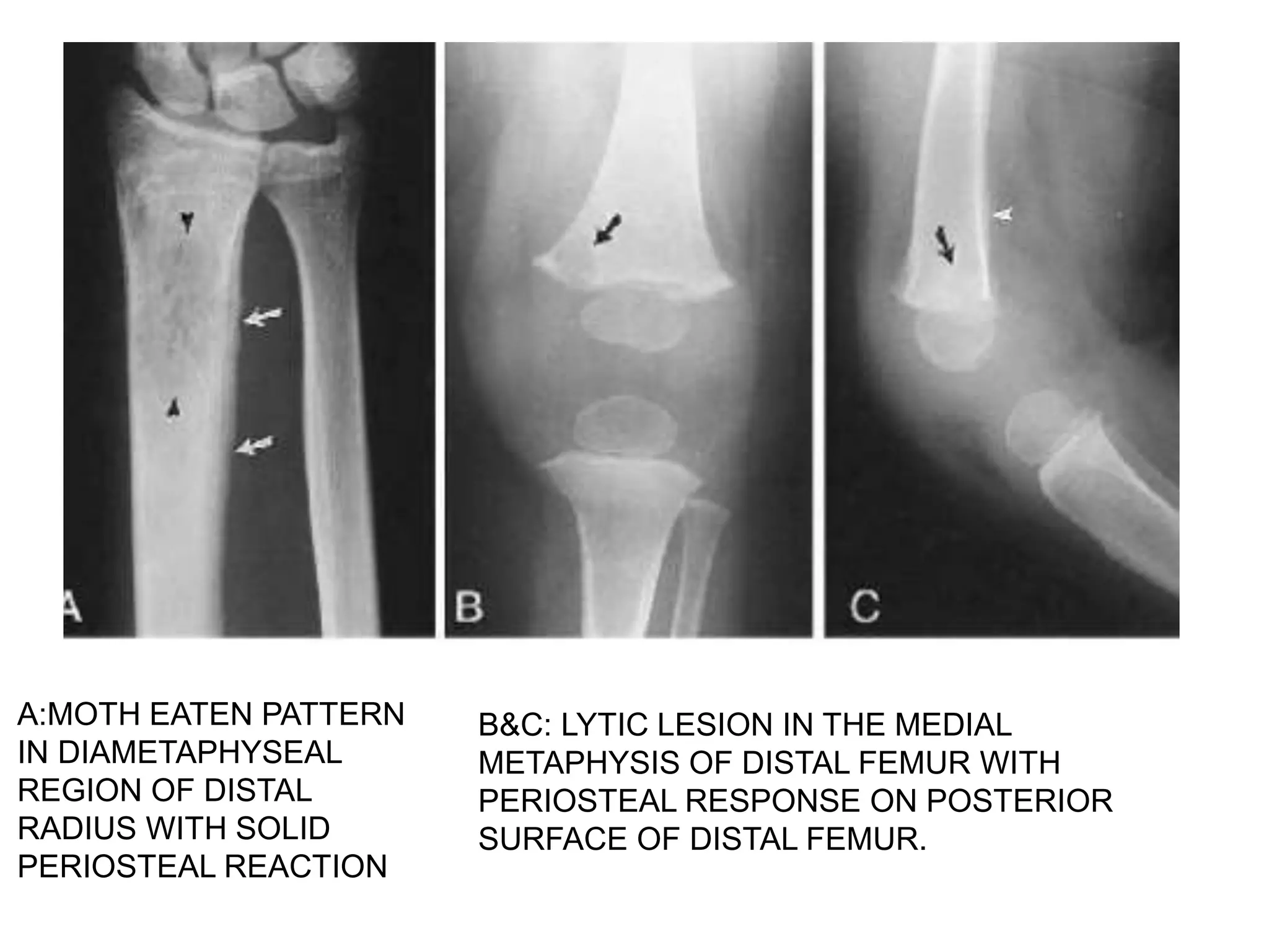 Bone and joint infections | PPTX