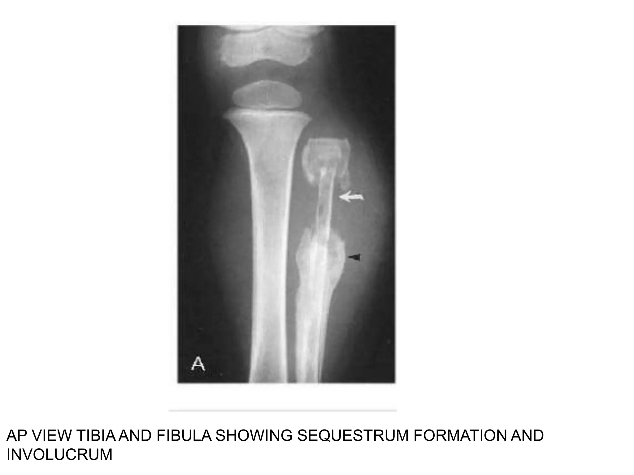 Bone and joint infections | PPTX