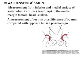 Bone and joint infections | PPTX