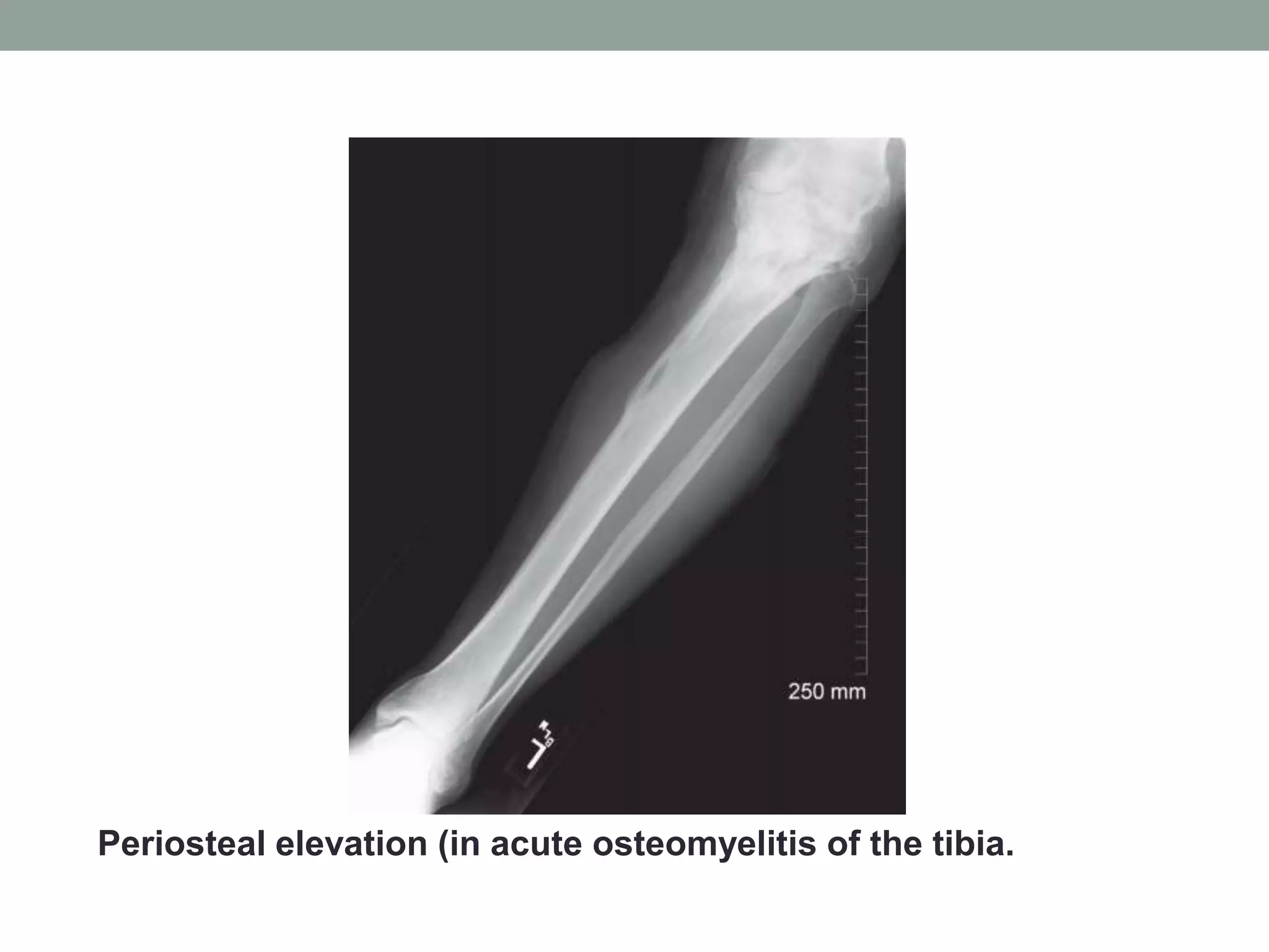 bone and joint infections.pptx