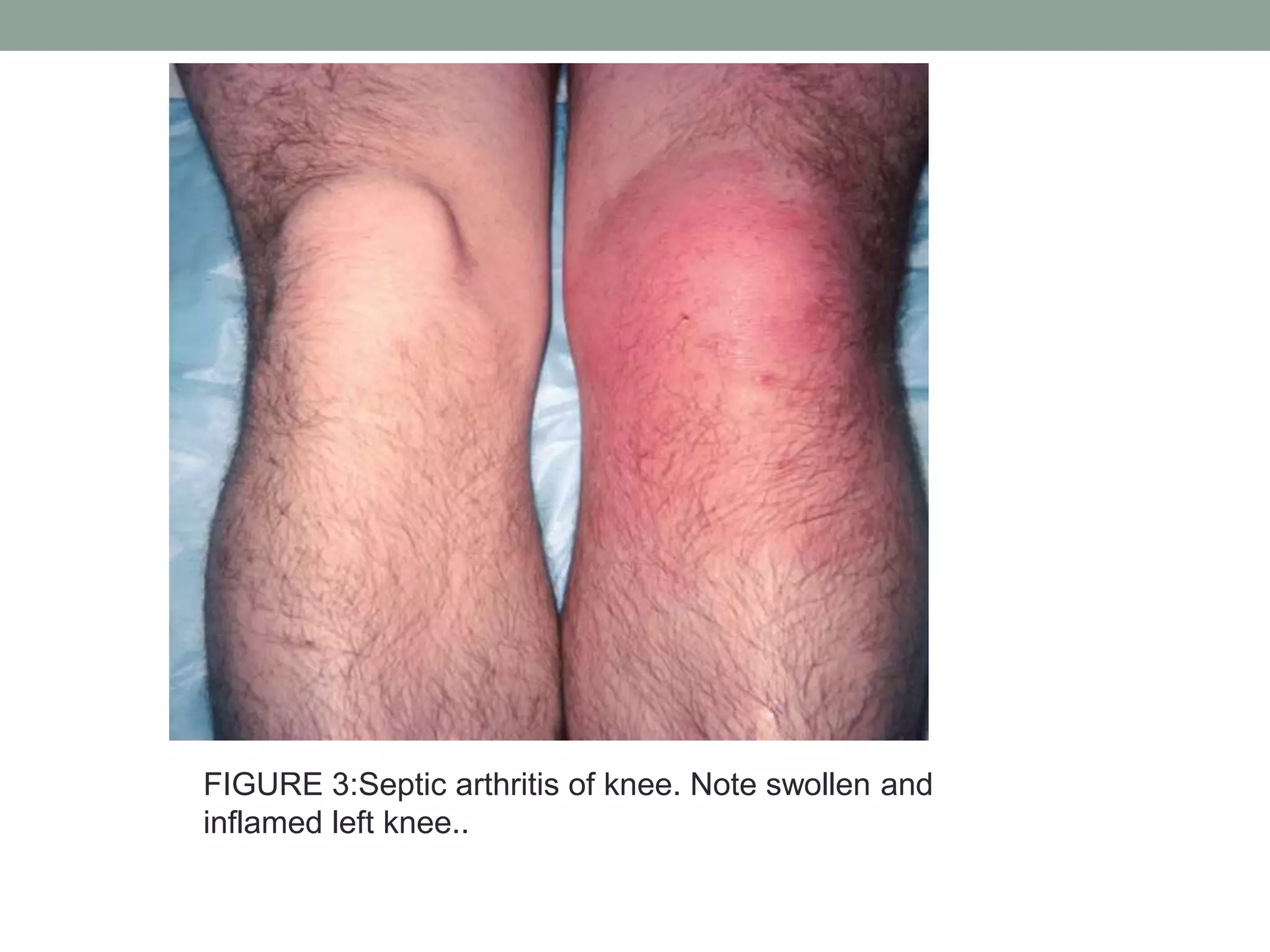 bone and joint infections.pptx